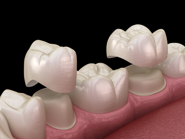 Dental Crowns in Roanoke, AL | All Smiles Dental Care